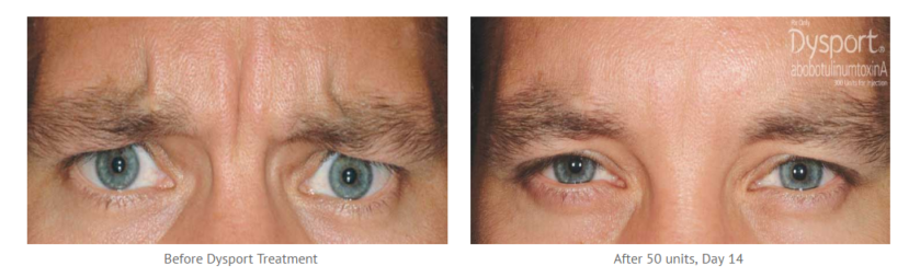 Dysport NYC | Dysport Treatment | Injectable Filler | Cosmetic Filler
