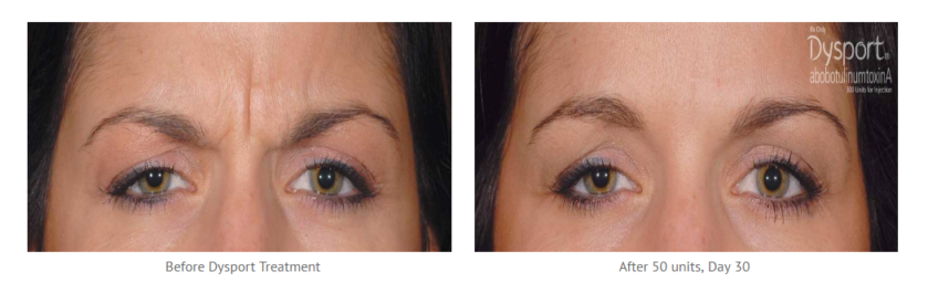 Dysport NYC | Dysport Treatment | Injectable Filler | Cosmetic Filler