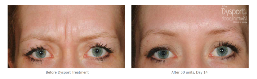 Dysport NYC | Dysport Treatment | Injectable Filler | Cosmetic Filler