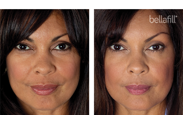 Bellafill NYC | Bellafill Treatment | Dermal Filler Treatment