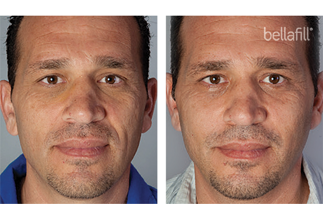 Bellafill NYC | Bellafill Treatment | Dermal Filler Treatment