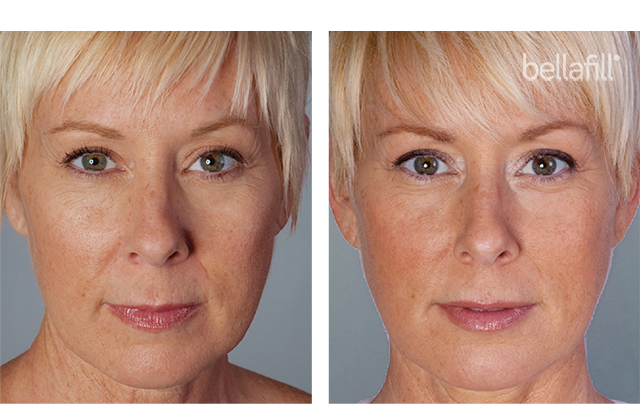 Bellafill NYC | Bellafill Treatment | Dermal Filler Treatment