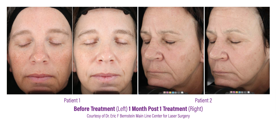 UltraClear™ Laser Treatment NYC | Dagan MD Facial Plastic Surgery