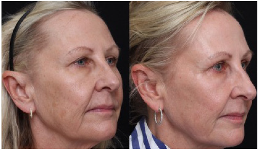 Facial Resurfacing Treatment NYC | Dagan MD Facial Plastic Surgery