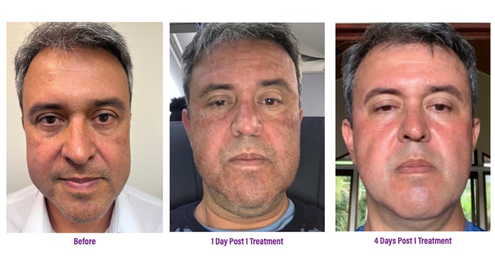 UltraClear™ Laser Treatment NYC | Dagan MD Facial Plastic Surgery