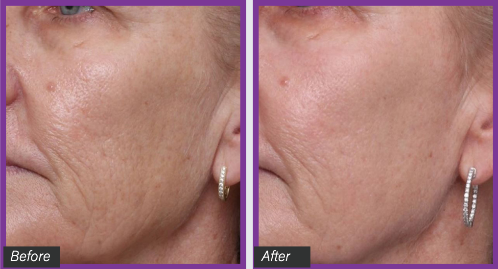 UltraClear™ Laser Treatment NYC | Dagan MD Facial Plastic Surgery