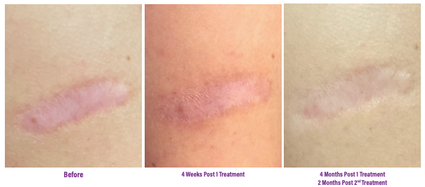 Before & After Photo Gallery | Laser Skin Treatment Gallery NYC