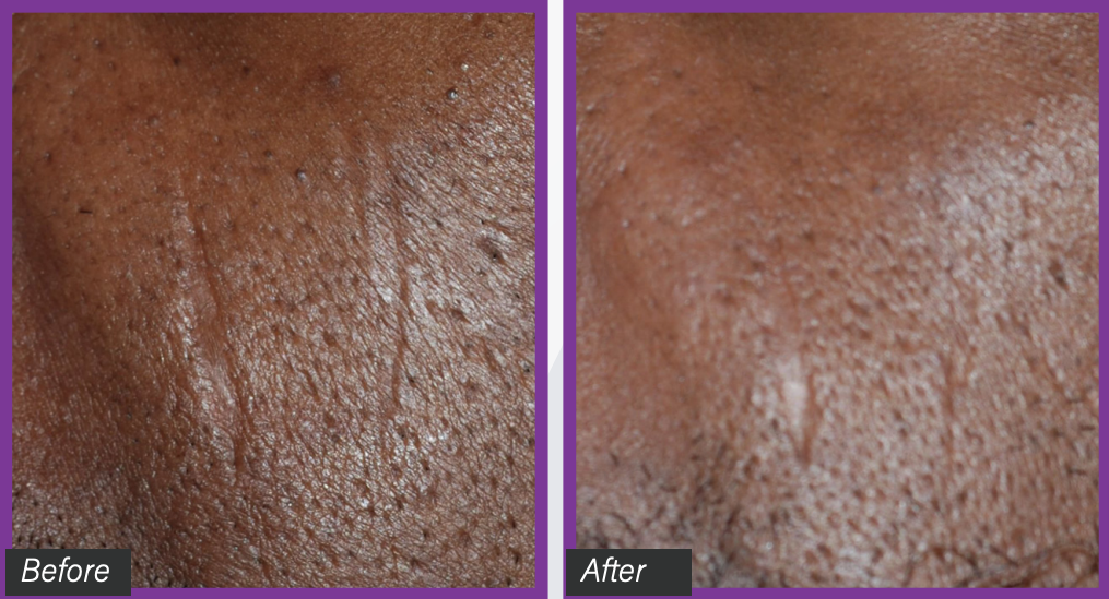 UltraClear™ Laser Treatment NYC | Dagan MD Facial Plastic Surgery