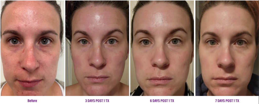 Loose Skin Surgery & Removal in NYC | Ultraclear Laser for Skin of Color