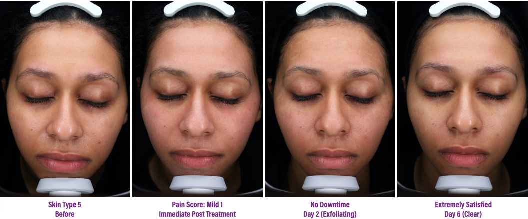 Loose Skin Surgery & Removal in NYC | Ultraclear Laser for Skin of Color