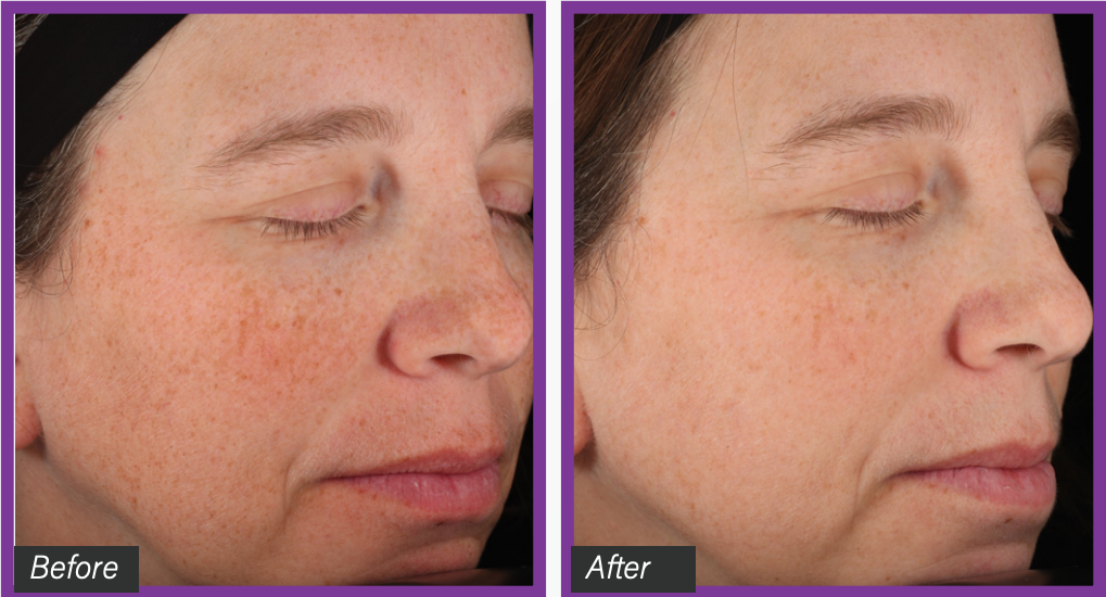 Before & After Photo Gallery | Laser Skin Treatment Gallery NYC